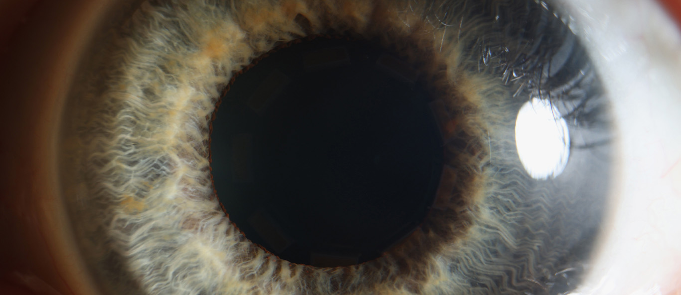 Cornea Ulcer Eye Corneal Ulcer Bajaj Eye Centre