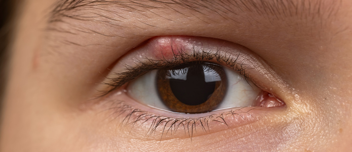 Eyelid Conditions | Hamilton & Princeton, NJ